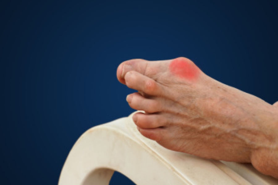 Facts About Bunion Surgery
